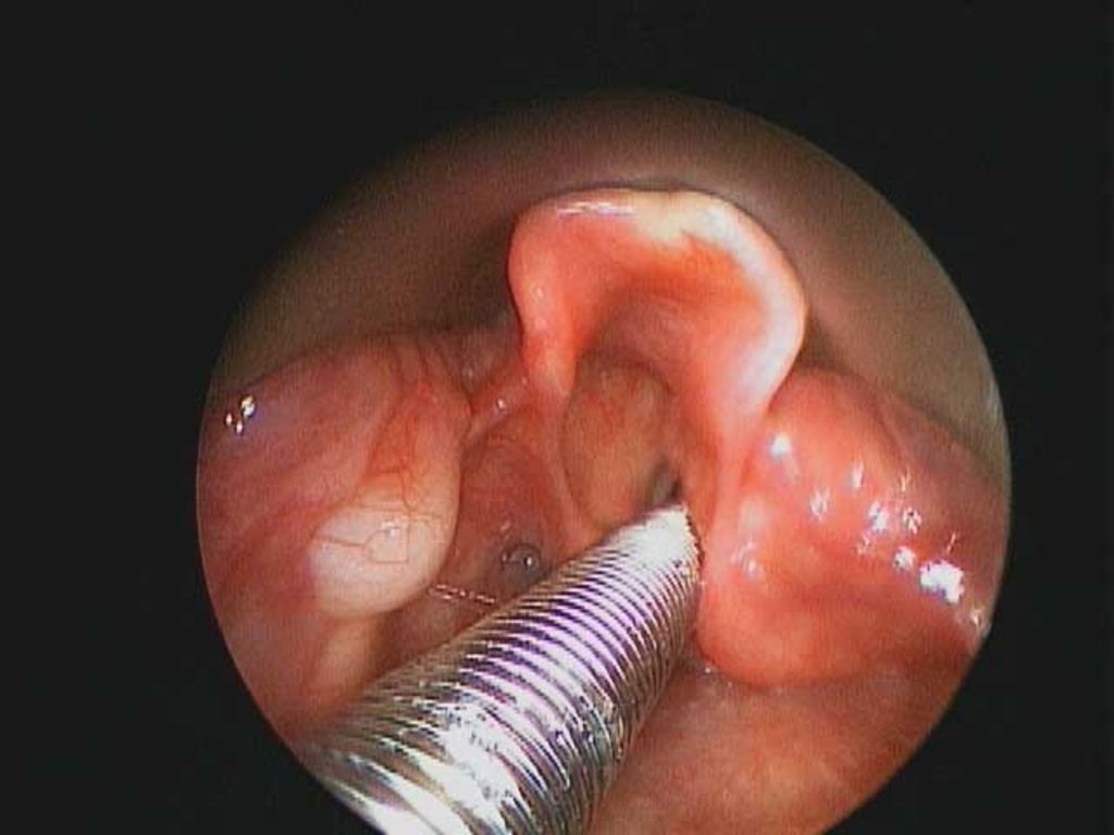 Saccular Cyst of the Larynx with Endoscopic Removal - Case Example ...