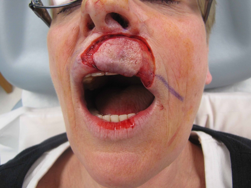 Lip Reconstruction Peri-alar Crescentic Advancement Flap - Clinical ...