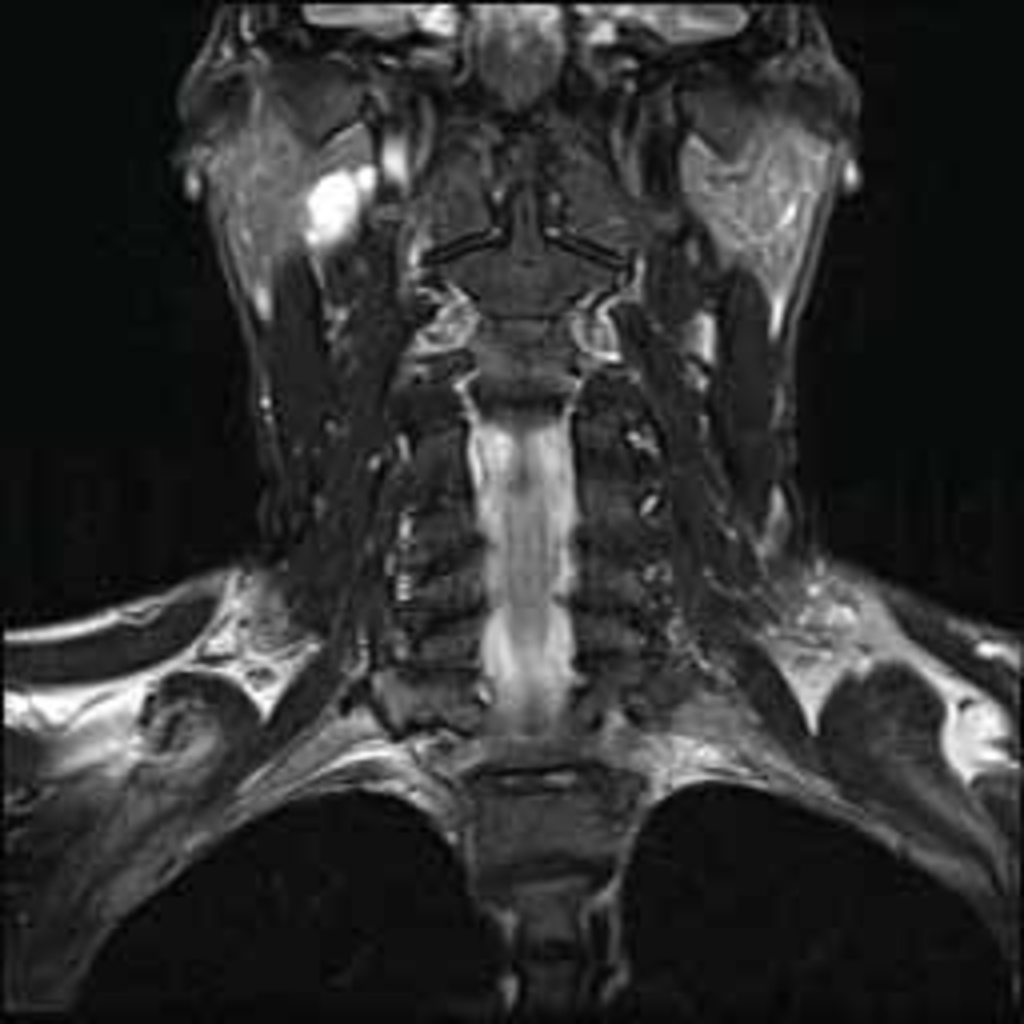 Deep Lobe Parotid Tumor/Parapharyngeal Space Pleomorphic Adenoma ...