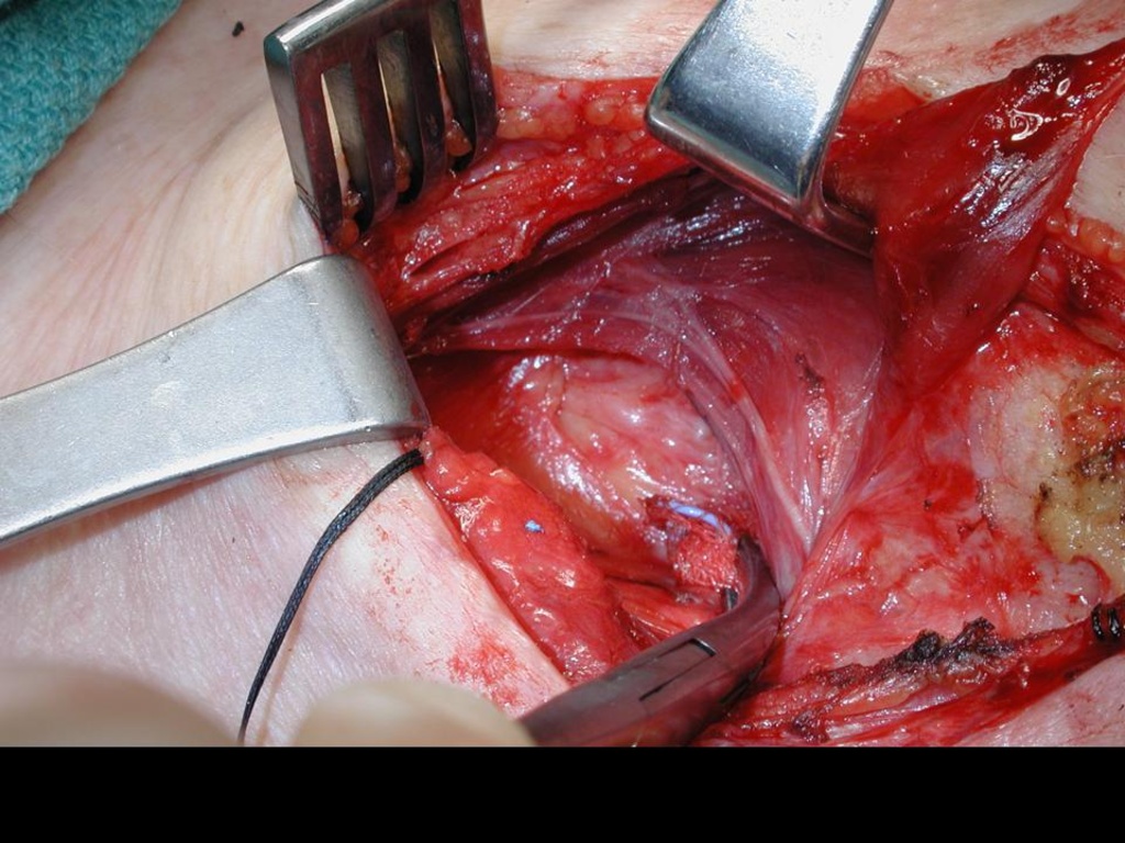 Reinnervation for Laryngeal Paralysis | Iowa Head and Neck Protocols ...