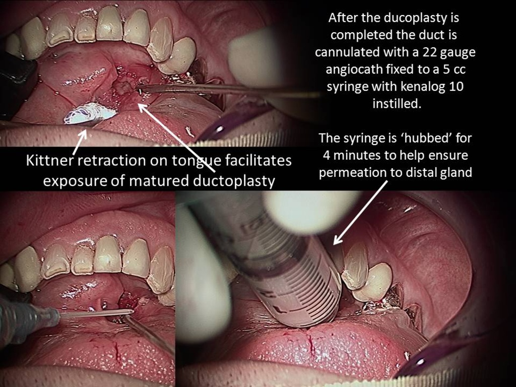 Sialodochoplasty (Complex) for Right Submandibular Sialadenitis with ...