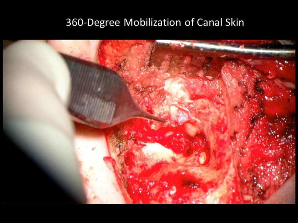 Subtotal Petrosectomy | Iowa Head and Neck Protocols - Carver College ...