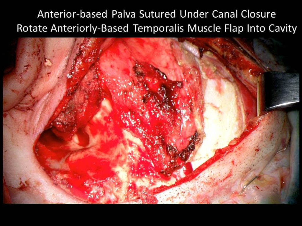 Subtotal Petrosectomy | Iowa Head and Neck Protocols - Carver College ...