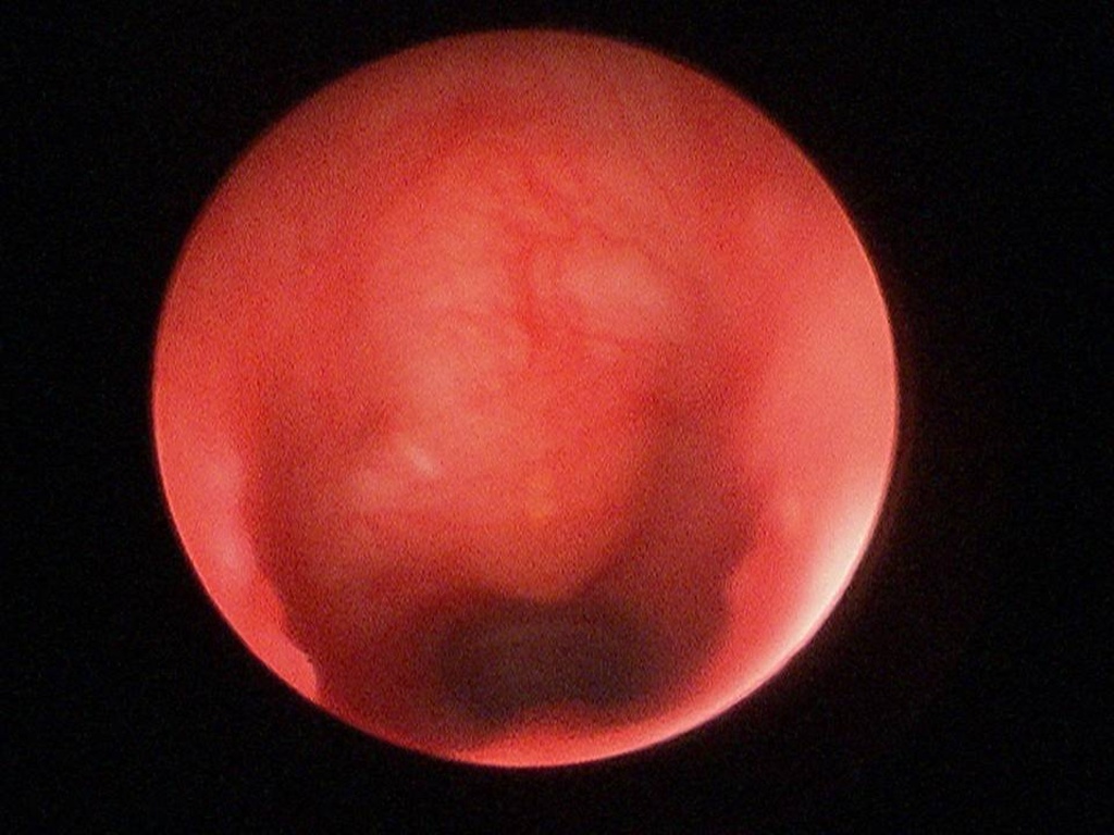 Congenital Laryngeal/Glottic Web | Iowa Head and Neck Protocols ...