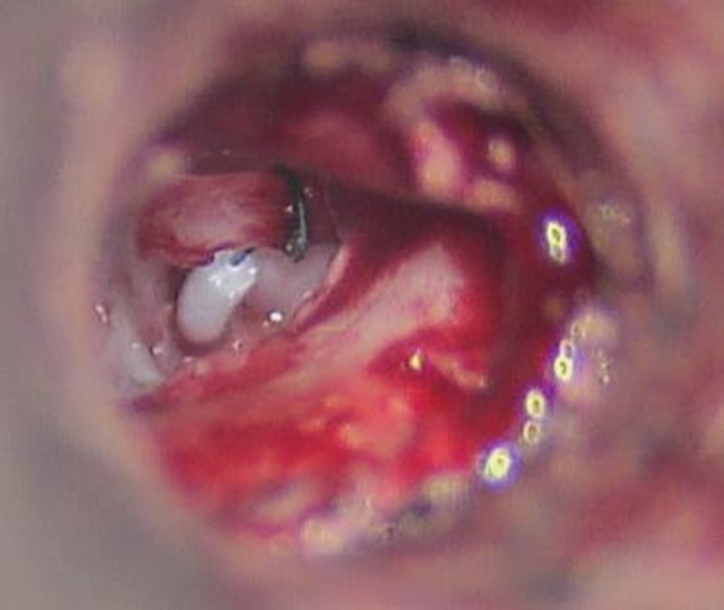 Stapedotomy | Iowa Head and Neck Protocols - Carver College of Medicine ...