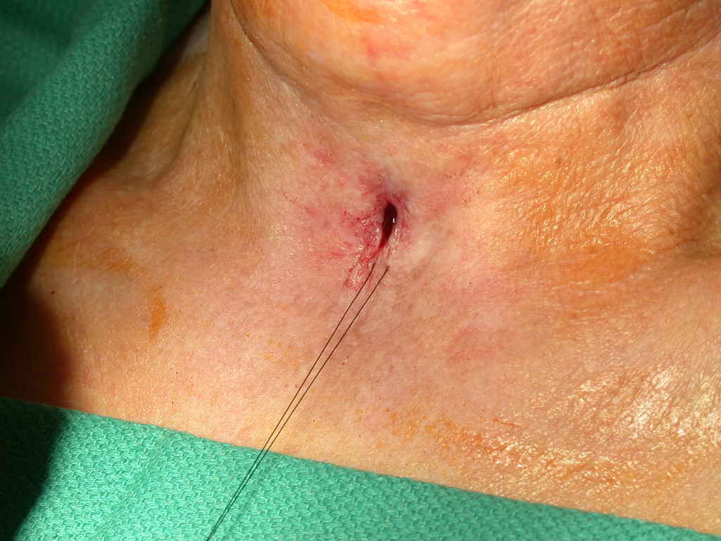 Tracheocutaneous Fistula Closure | Iowa Head and Neck Protocols ...