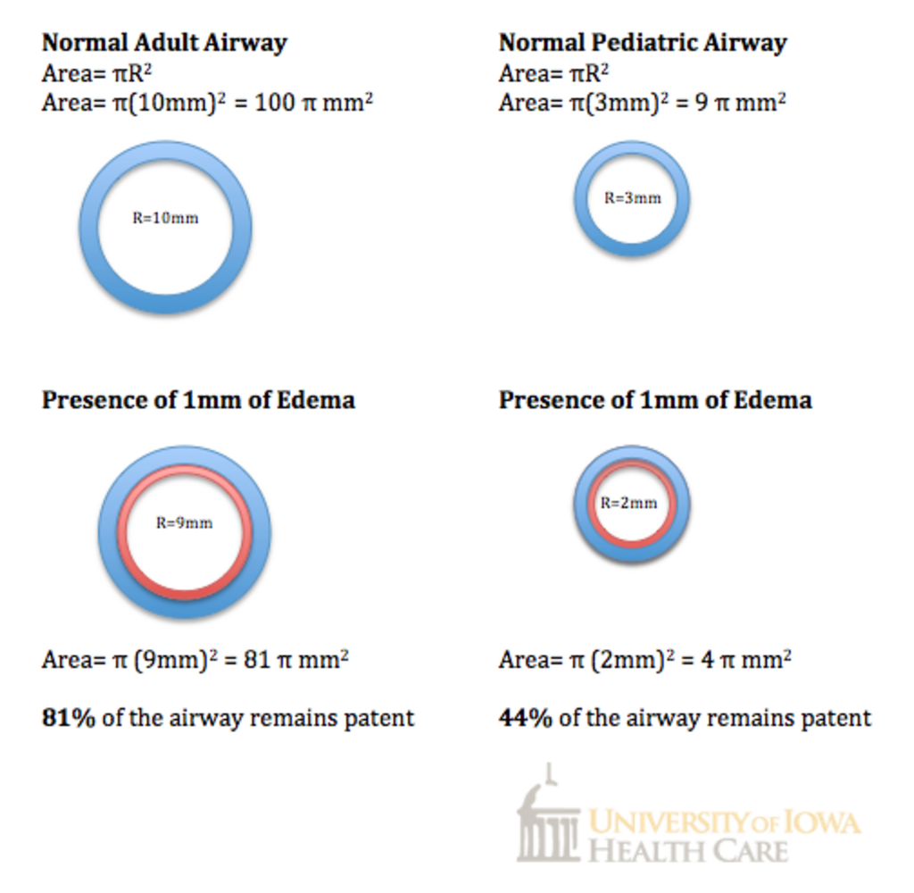 The Evaluation of Stridor in Pediatric Patients | Iowa Head and Neck ...
