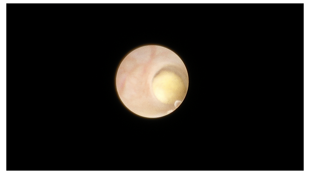 Laser Management of Submandibular Salivary Gland Stone (Sialolithiasis ...