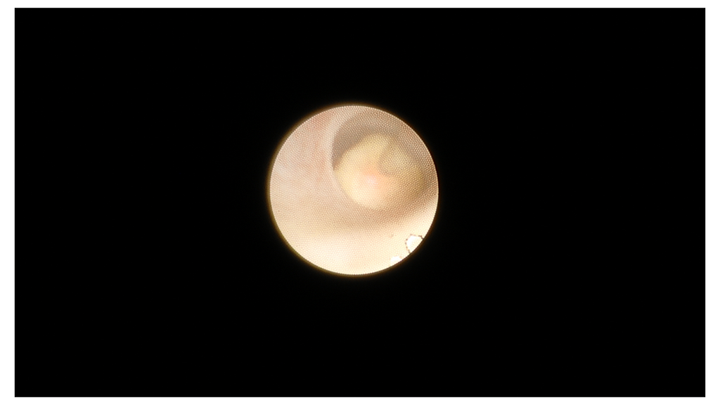 Laser Management of Submandibular Salivary Gland Stone (Sialolithiasis ...