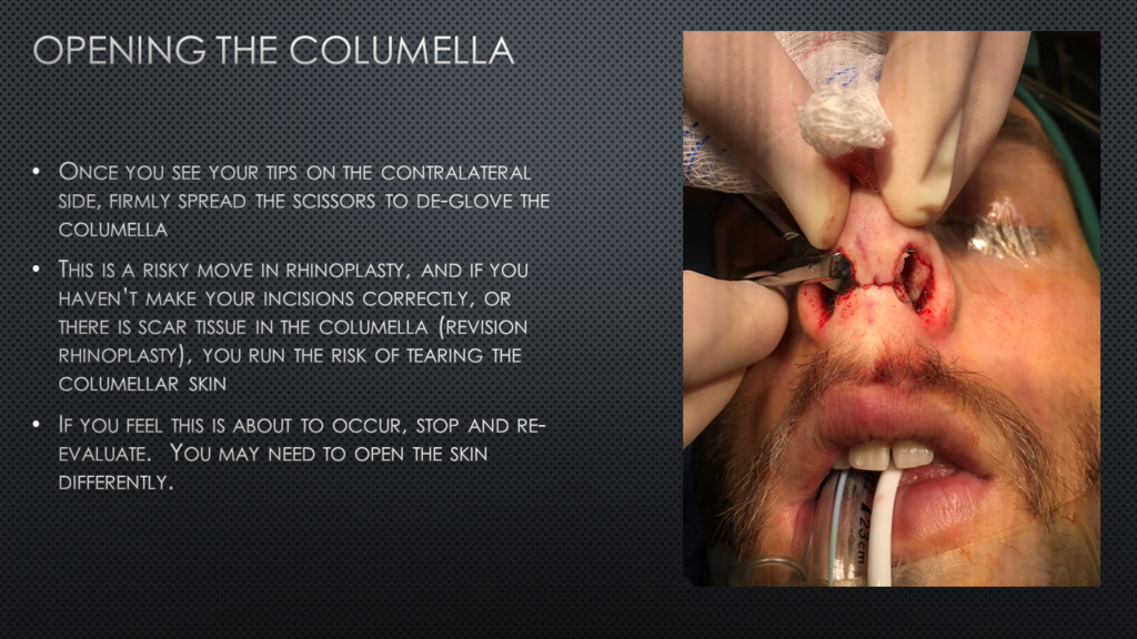 Open Septorhinoplasty - Surgical Demonstration (Rhinoplasty) | Iowa ...