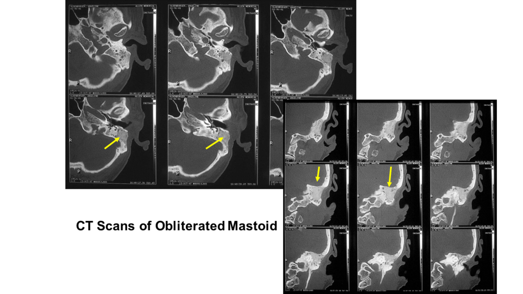 Canal Wall Reconstruction (Mastoidectomy) | Iowa Head and Neck ...