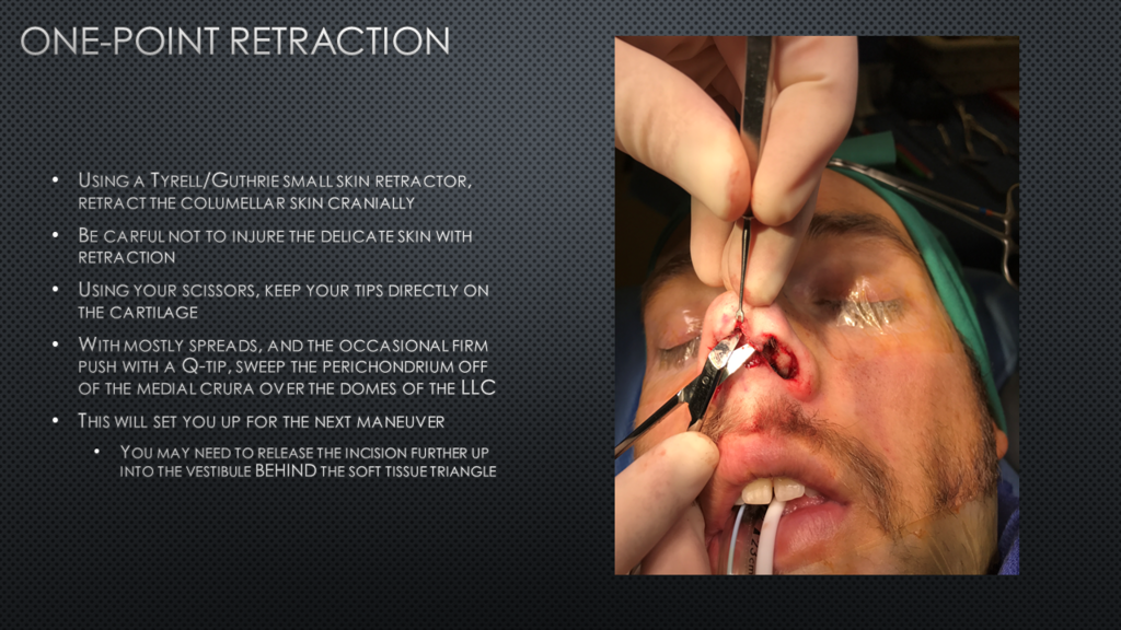 Open Septorhinoplasty - Surgical Demonstration (Rhinoplasty) | Iowa ...