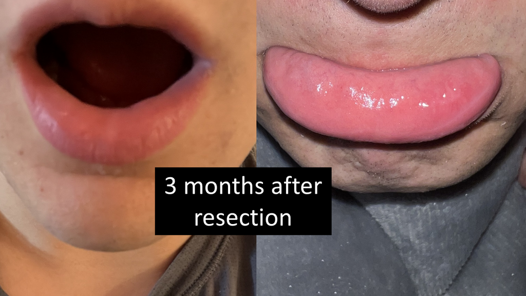 Lower Lip Bump (Mucocele versus Mucus Retention Cyst) Minor Salivary ...