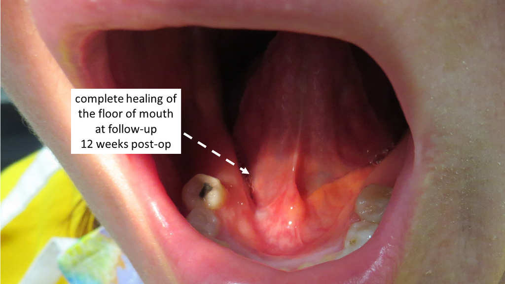 Submandibular Gland Anatomy: The Uncinate Process of the Deep Lobe ...