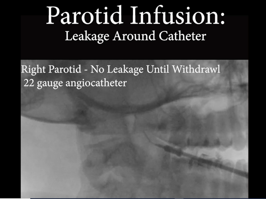 Leakage Around Catheter at Duct Orifice During Parotid Gland Infusion ...