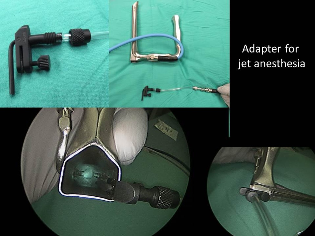 Jet Anesthesia Adapter | Iowa Head and Neck Protocols - Carver College ...