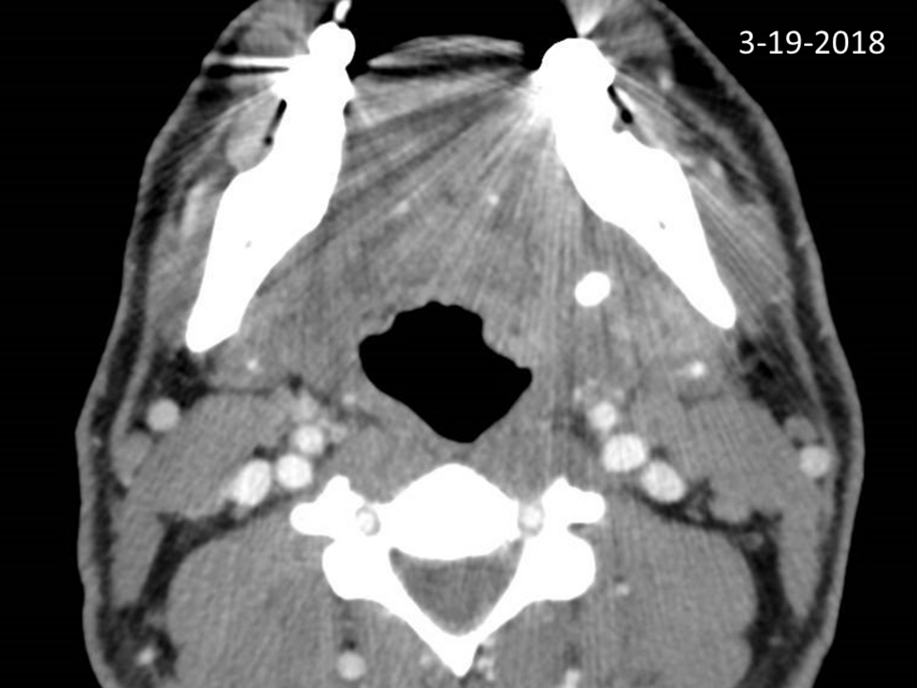 Submandibular Abscess from Stone | Iowa Head and Neck Protocols ...