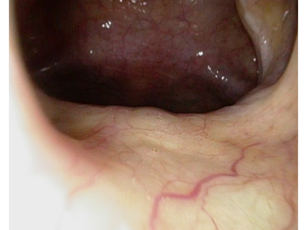 Passavant's Ridge (Passavant's Pad) and Velopharyngeal Incompetence ...