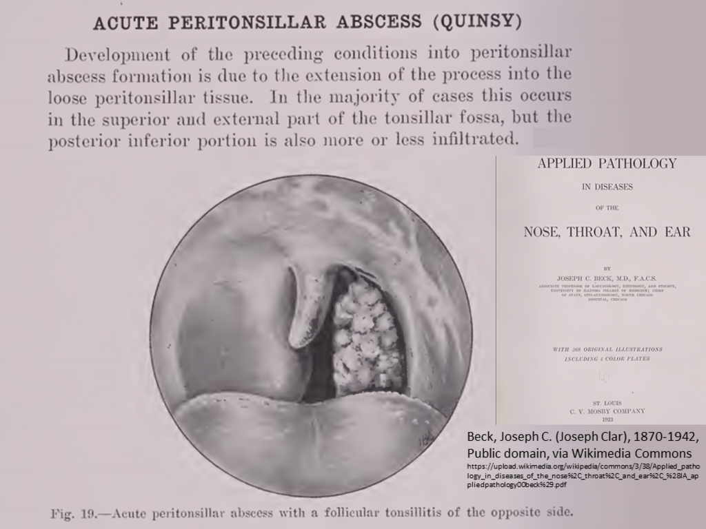 Peritonsillar Abscess (PTA) Management | Iowa Head and Neck Protocols ...