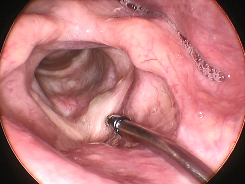 Vocal Cord Injection with Prolaryn Gel with Videostroboscopy (Transoral ...