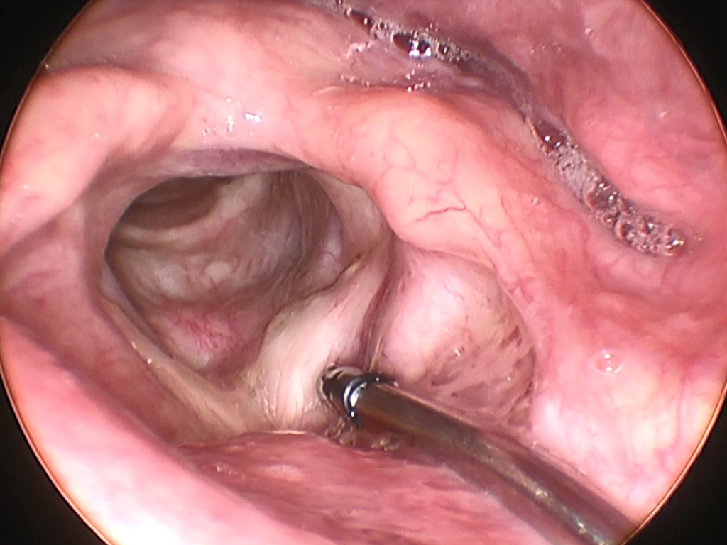 Vocal Cord Injection with Prolaryn Gel with Videostroboscopy (Transoral ...