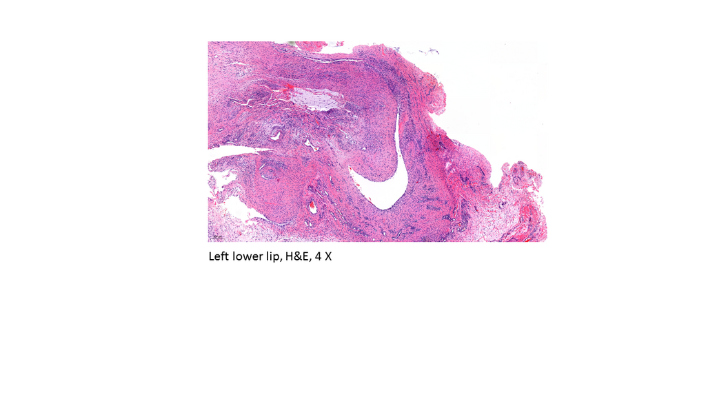 Lower Lip Bump (Mucocele versus Mucus Retention Cyst) Minor Salivary ...