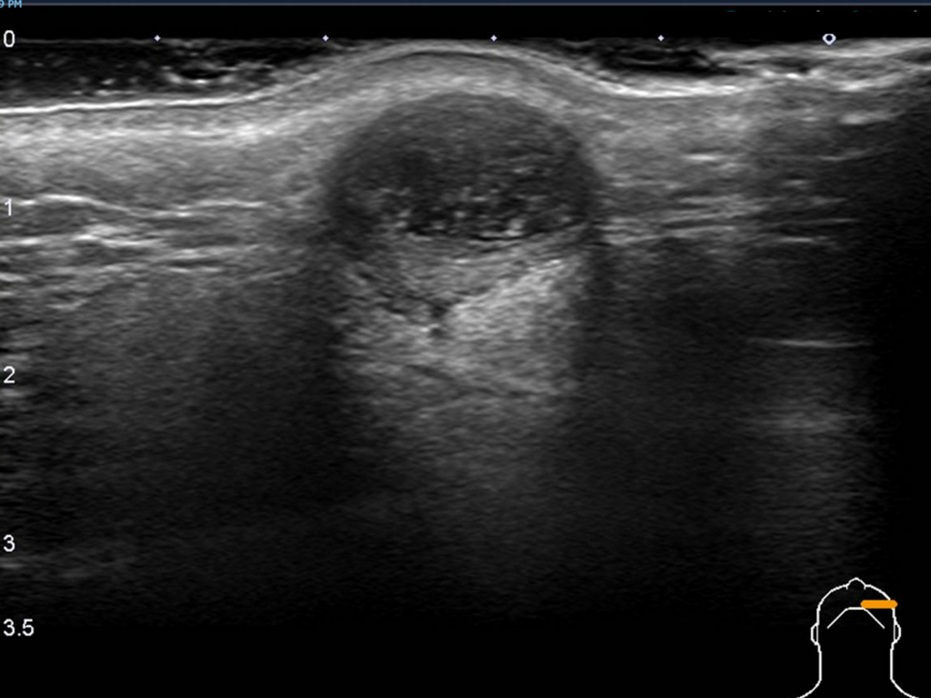 Lymphadenoma of the Parotid (Non-Sebaceous Prominent) | Iowa Head and ...