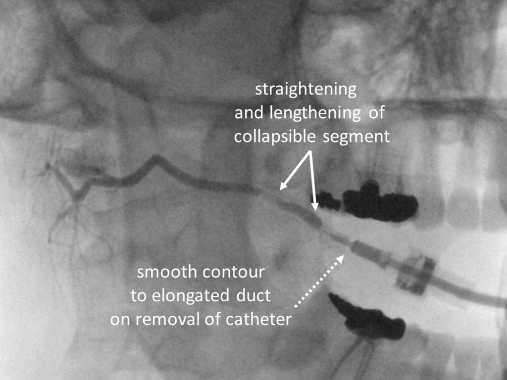 Parotid Duct Elongation and Dilation from Chronic Distal Obstruction ...