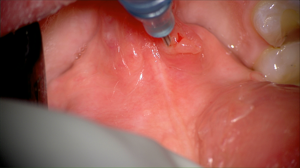 Laser Management of Submandibular Salivary Gland Stone (Sialolithiasis ...