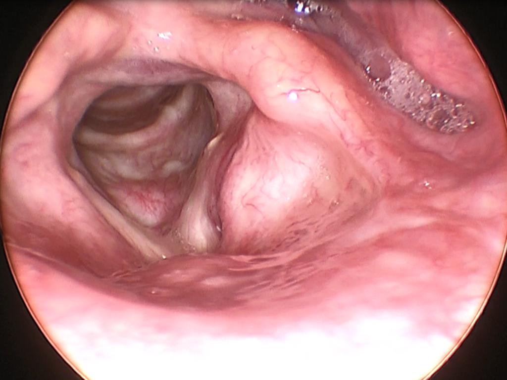 Vocal Cord Injection With Prolaryn Gel With Videostroboscopy Transoral