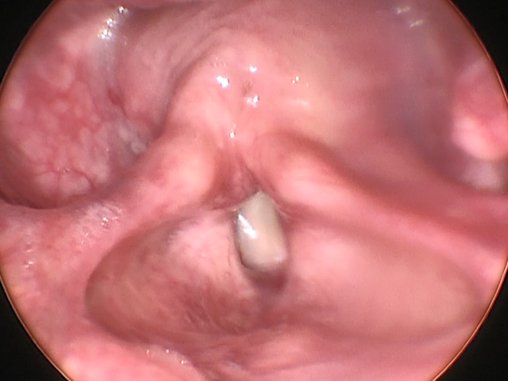 Vocal Cord Injection with Prolaryn Gel with Videostroboscopy (Transoral ...