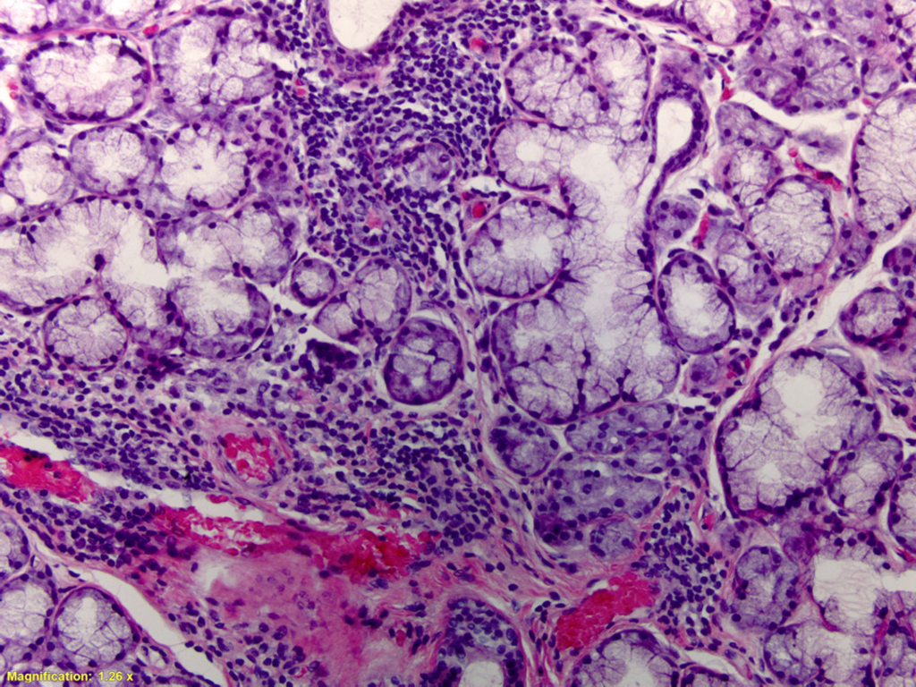 Lip Biopsy of Minor Salivary Gland Histopathology for Sjogren's ...