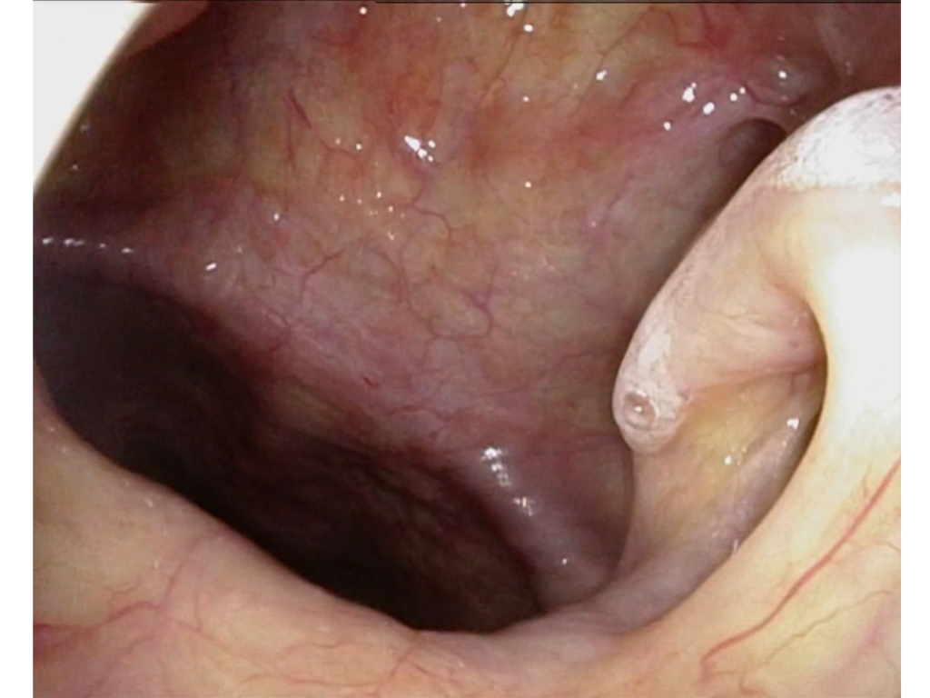 Passavant's Ridge (Passavant's Pad) and Velopharyngeal Incompetence ...