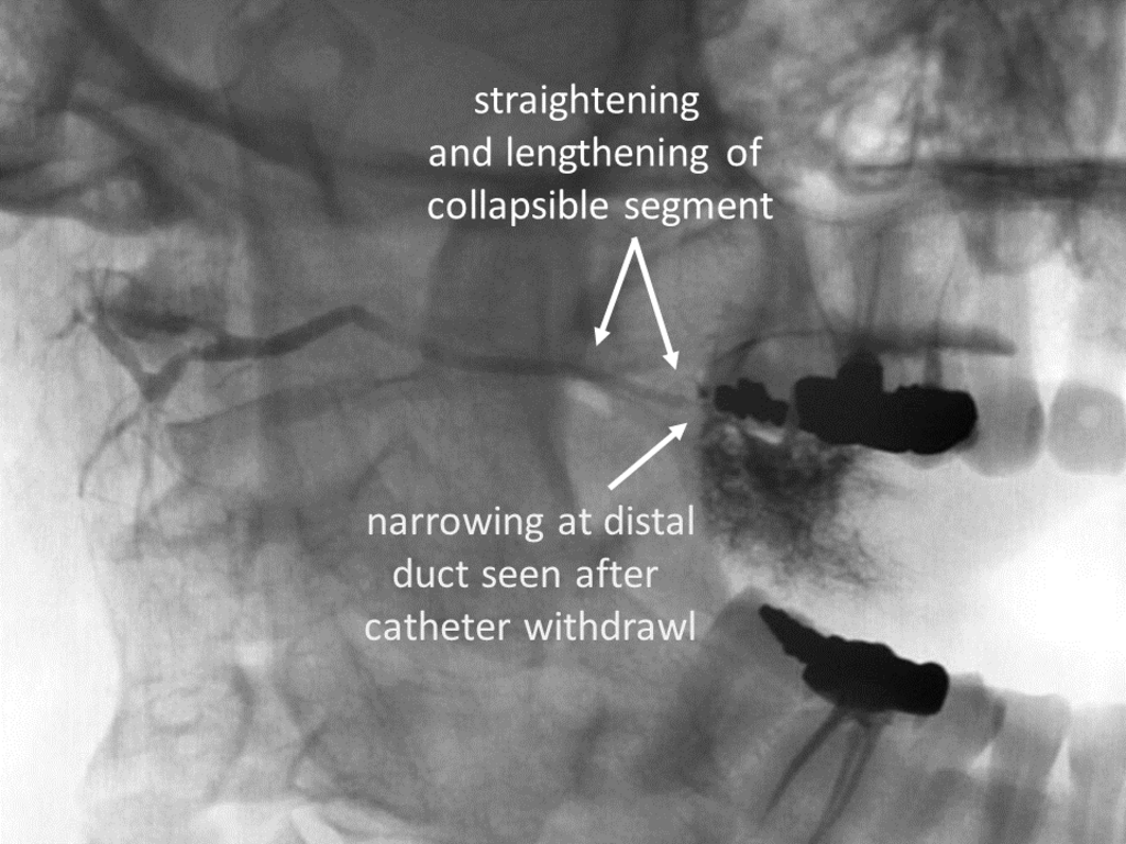 Parotid Duct Elongation and Dilation from Chronic Distal Obstruction ...