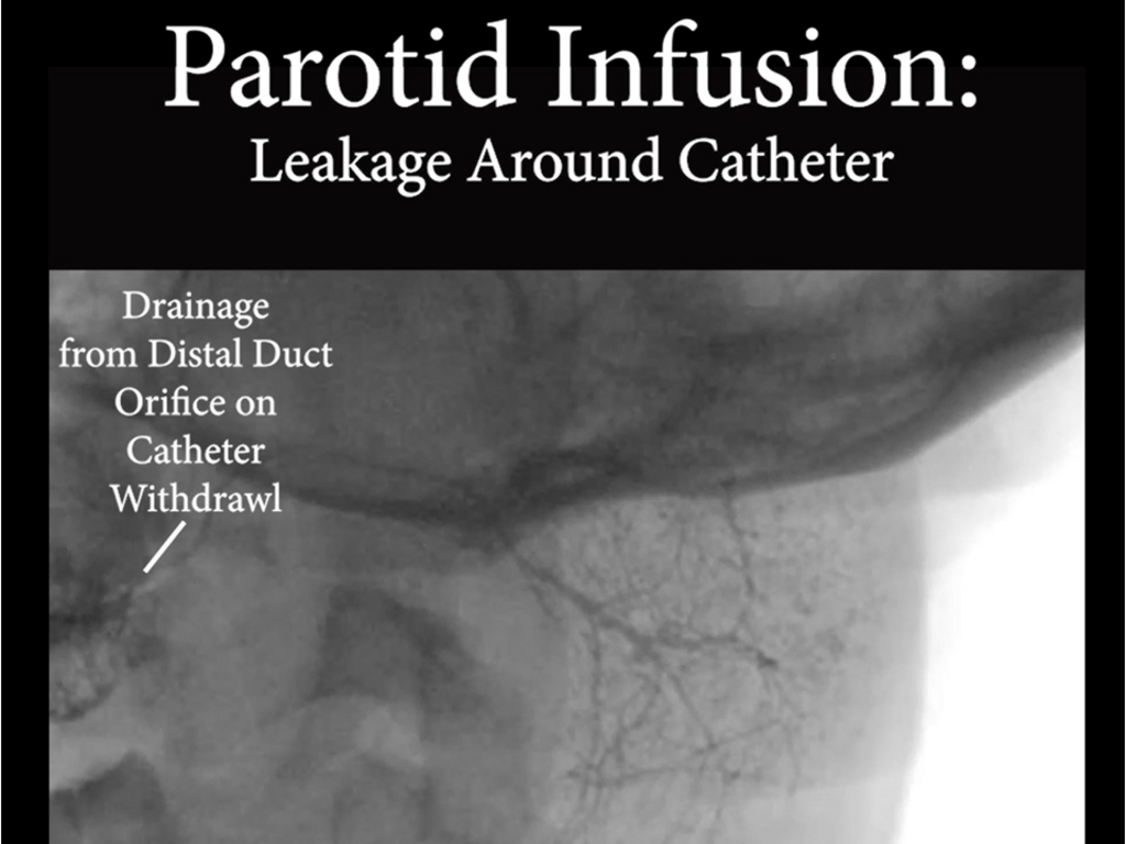 Leakage Around Catheter at Duct Orifice During Parotid Gland Infusion ...