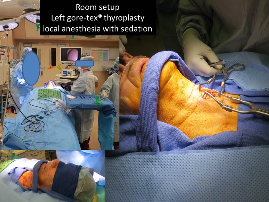 Setup for Thyroplasty (Medialization Laryngoplasty) | Iowa Head and ...