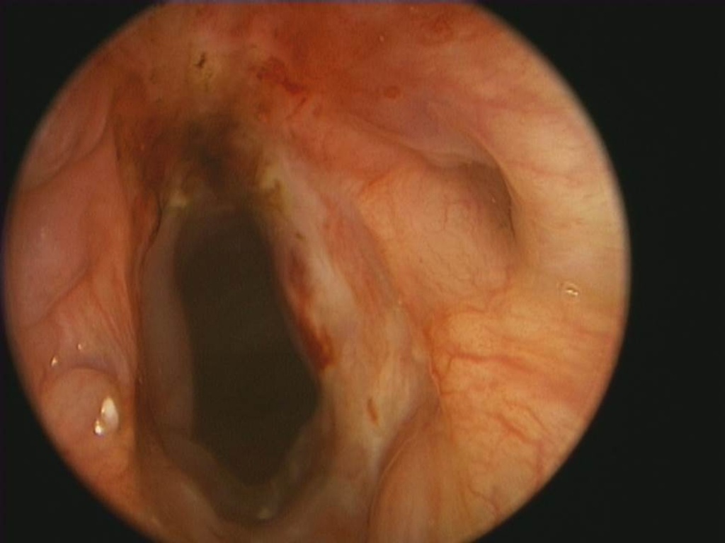 Anterior Glottic Web | Iowa Head and Neck Protocols - Carver College of ...