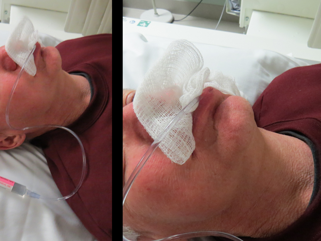 Sialogram Technique | Iowa Head and Neck Protocols - Carver College of ...