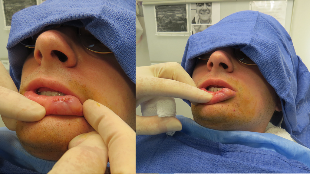 Lower Lip Bump (Mucocele versus Mucus Retention Cyst) Minor Salivary ...