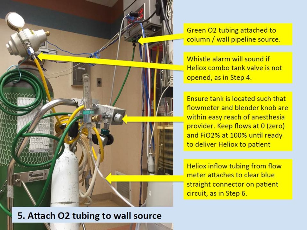 Heliox Setup for the Difficult Airway | Iowa Head and Neck Protocols ...