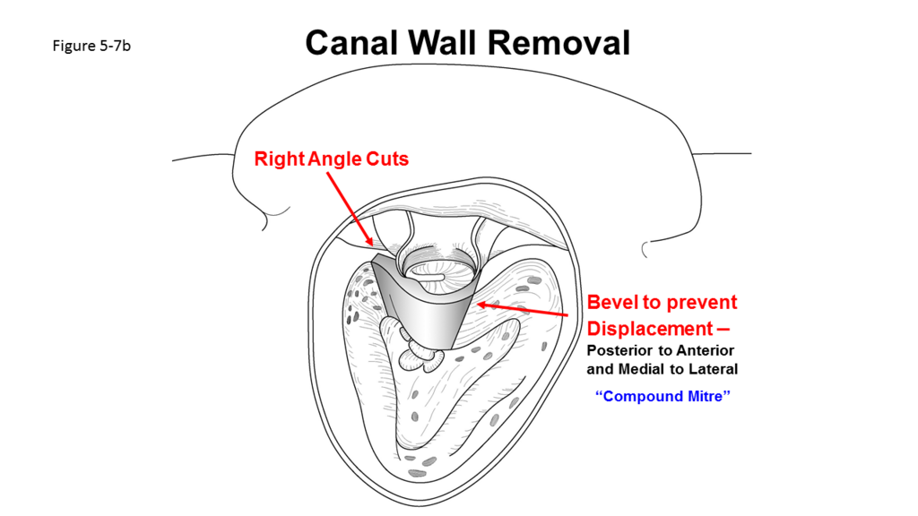Canal Wall Reconstruction (Mastoidectomy) | Iowa Head and Neck ...