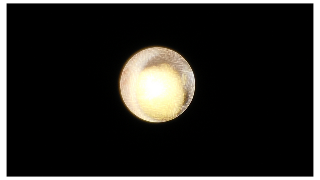 Laser Management of Submandibular Salivary Gland Stone (Sialolithiasis ...