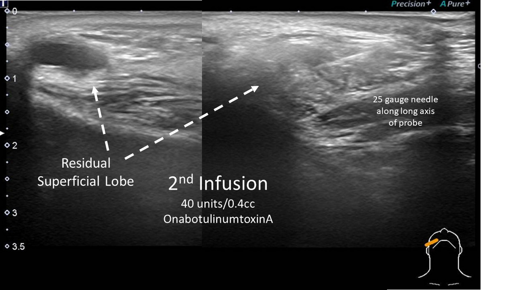 Sialadenitis after Parotidectomy Treatment with Repeated Ultrasound ...