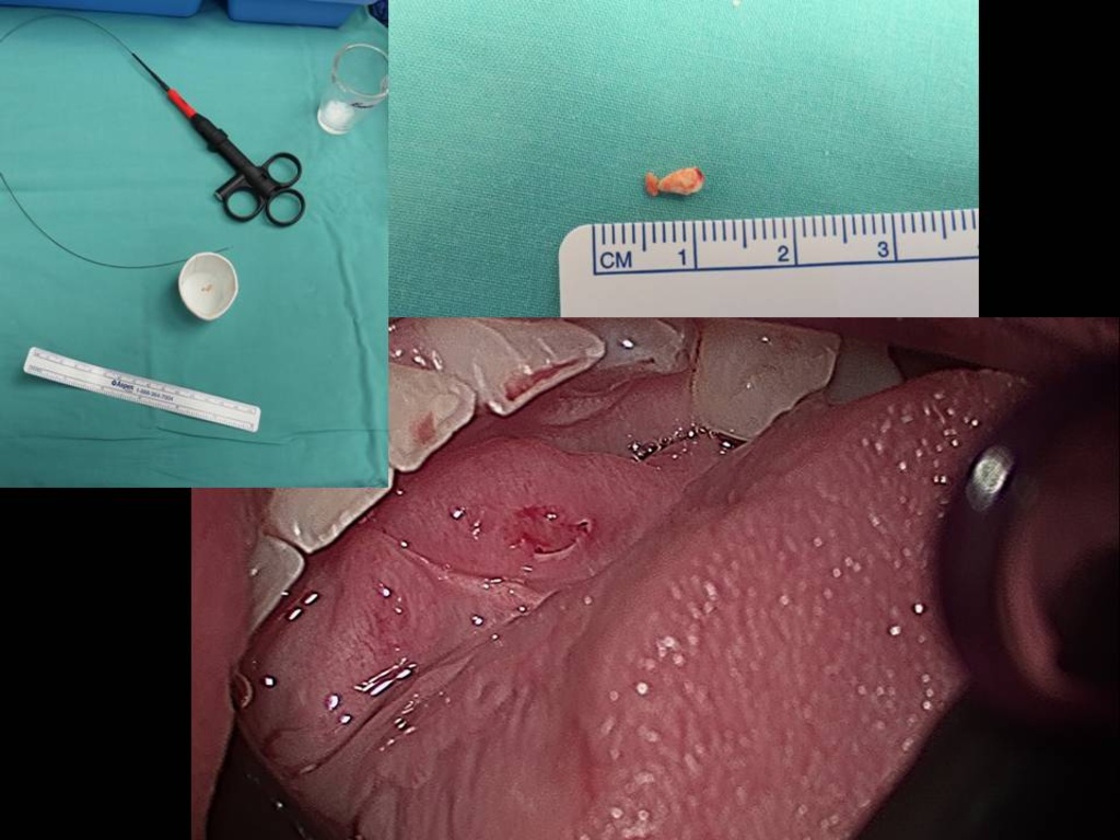 Bartholin's Duct Anatomy | Iowa Head and Neck Protocols - Carver ...
