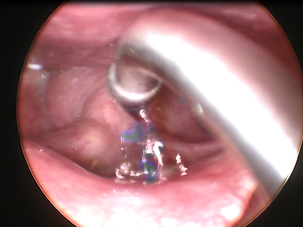 Vocal Cord Injection with Prolaryn Gel with Videostroboscopy (Transoral ...