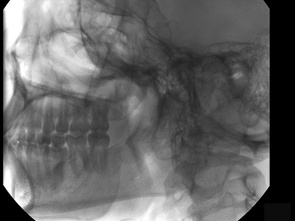 Juvenile Recurrent Parotitis Sialogram | Iowa Head and Neck Protocols ...