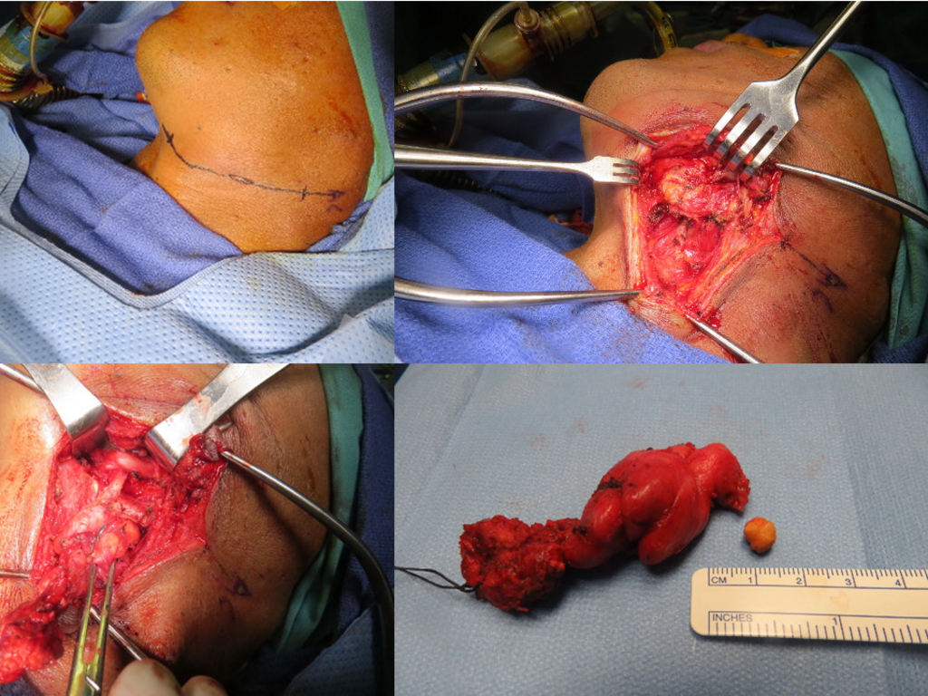 Submandibular Abscess from Stone | Iowa Head and Neck Protocols ...