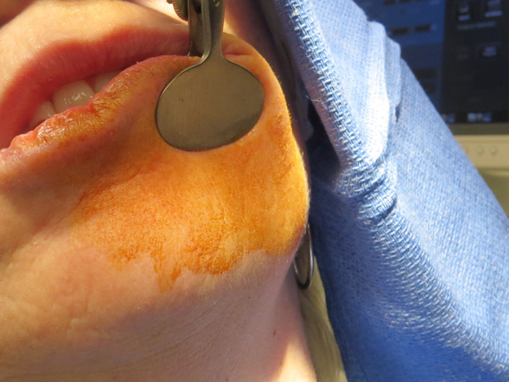 Lip Biopsy for Sjogren's Syndrome (Minor Salivary Gland Biopsy) Using ...