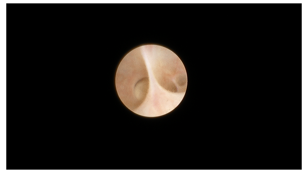 Laser Management of Submandibular Salivary Gland Stone (Sialolithiasis ...