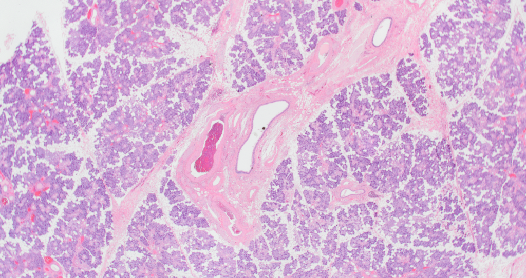 Submandibular Gland Anatomy: The Uncinate Process of the Deep Lobe ...